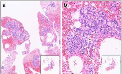 A A Large Area Of Bone Marrow Tissue Was Replaced By Poorly Download Scientific Diagram