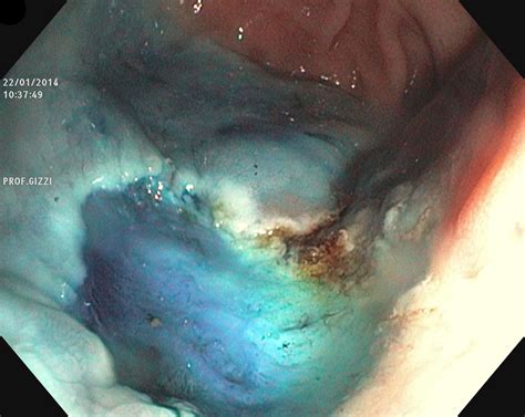13c Post Polypectomy Scar Colon Explorer