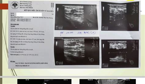 Vietnamese Medic Ultrasound Case 716 Sister Mary Joseph Nodule And Axillary Node Metastasis