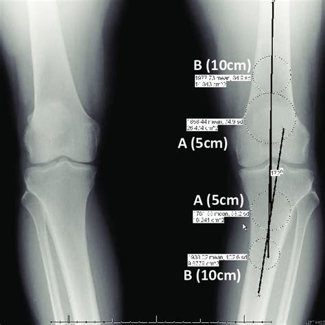 Four Different Methods Of Measuring Tibial Slope Anterior Tibial Download Scientific Diagram