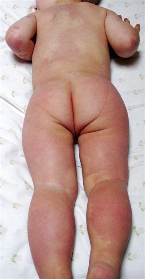 In Diffuse Capillary Malformation Cm With Overgrowth Distribution Of