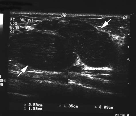 Case 1 Phyllodes Phylloides Or Cystosarcoma Phyllodes Tumor Wide Local Excision Is The