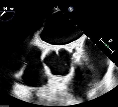 Transesophageal Echocardiogram Demonstrating A Prominent Crista