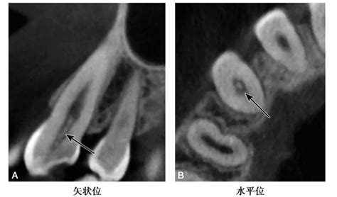 牙髓钙化的cbct表现 好医术文章 好医术 赋能医生守护生命