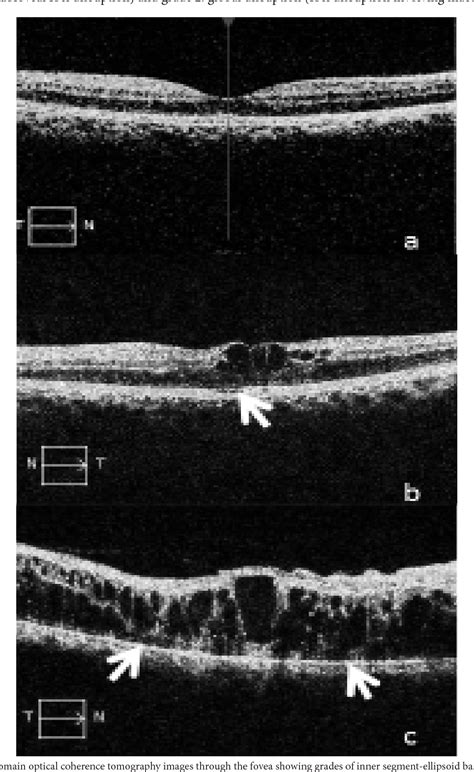 Retinal Photoreceptor Cell Inner Segment Semantic Scholar