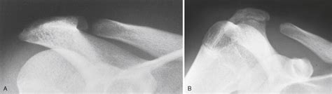 The Shoulder Girdle And Thoracic Cage Clinical Tree