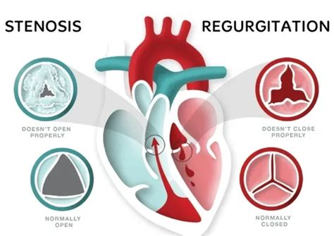 Valvular Heart Surgery