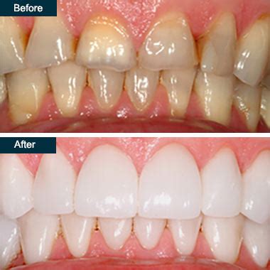 Porcelain Dental Crowns In Yonkers Ny Procedure And Cost
