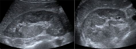 Figure 1 From Usefulness Of Diffusion Weighted Imaging In The Evaluation Of Pyelonephritis