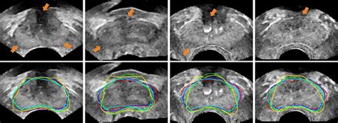 Visual Comparison Of Prostate Segmentation Results Top Row Prostate