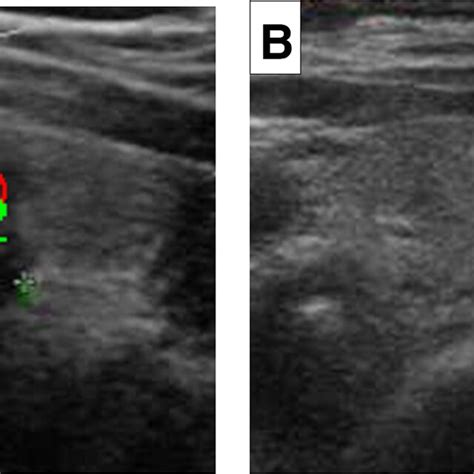 For Ptcs With Heterogeneous Echogenicity A Regions Of Interest