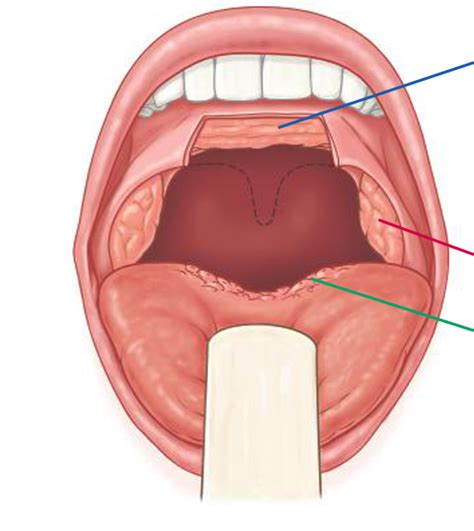 Tonsillitis Diagram