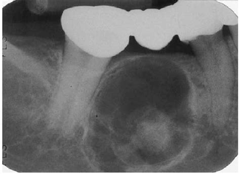 Ossifying Fibroma Of Teeth Cemento Ossifying Fibroma Slyi
