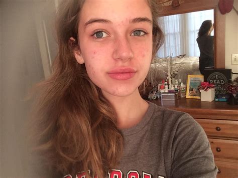 Acne Log Birth Control Doxycycline Adapalene Personal Logs Acne Org Forum