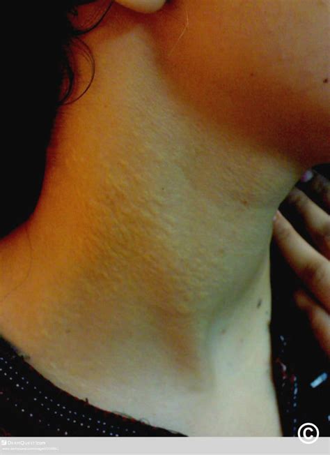 Pseudoxanthoma Elasticum Face
