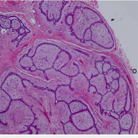 1 3 Cm Right Breast Mass Showing A Benign Phyllodes Tumor With Positive Download Scientific