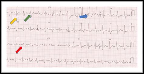 Figure The Blue Arrow Points The RsR Pattern With An R Of Great Download Scientific Diagram