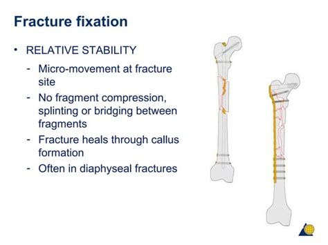 Principles Of Fracture Fixation