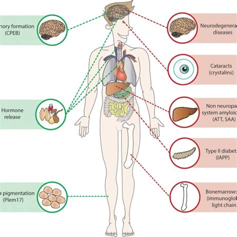 Clinical Features Of Systemic Al Amyloidosis A Macroglossia With