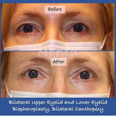 Under Eye Bags Treatment Dc Dark Circle Surgery