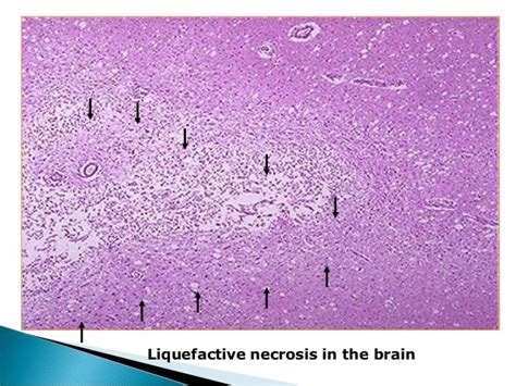 Necrosis Gangrene And Apoptosis