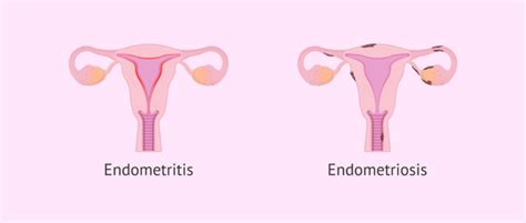 Endometritis Vs Endometriosis