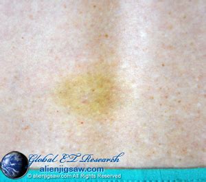 Post Et Abduction Body Marks