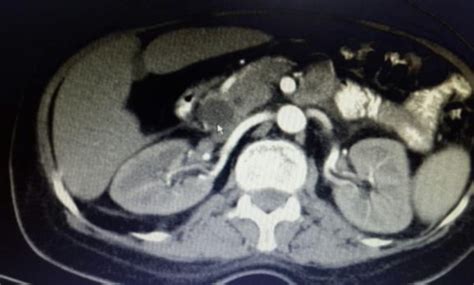 Facial Hyperpigmentation Any Link To Cancer Pmc