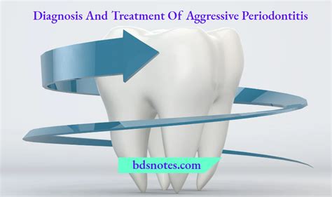 Diagnosis And Treatment Of Aggressive Periodontitis Bds Notes