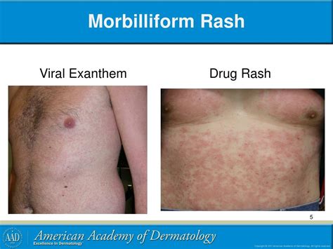 Ppt Viral Exanthems Powerpoint Presentation Free Download Id3302218