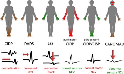 Chronic Inflammatory Demyelinating Polyneuropathy Update On Diagnosis