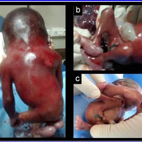 Aborted Foetus Viewed From Behind A Shows A Short Neck And The Hump