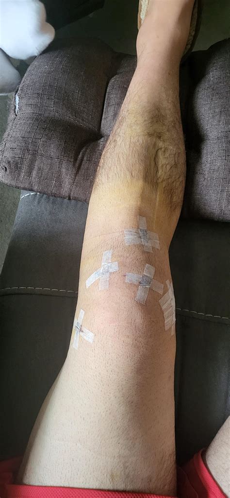 Acl Mcl Lcl And Meniscus Repair 7 Days Post Op R Acl