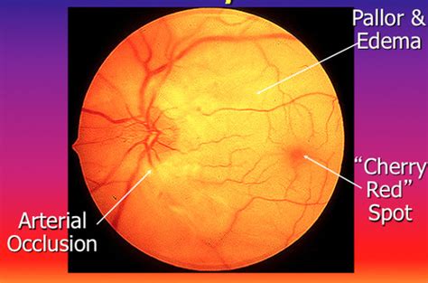 Retinal Disorders Pending Flashcards Quizlet