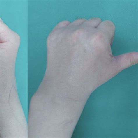 Intraoperative View Of The EIP To EPL Tendon Transfer Using Pulvertaft Download Scientific