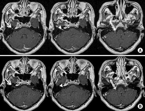 Internal Auditory Canal Mri