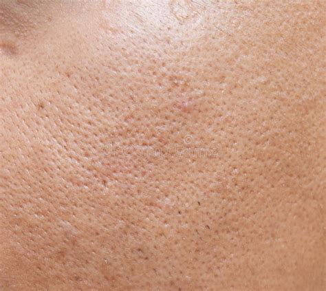 Textura Da Pele Com Poros Imagem De Stock Imagem De Dermatologia