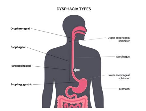 Oropharyngeal Dysphagia Dysphagia Jss Hospital
