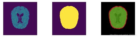 【医疗影像处理】erosion And Dilation Of Medical Images Masks Using Scipy Ndimage In Python 对医学3d分割图像进行腐蚀