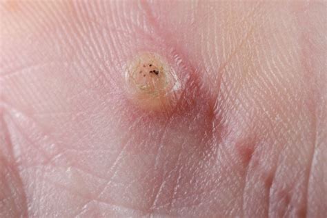 10 Symptoms And Treatments Of Anal Warts Facty Health
