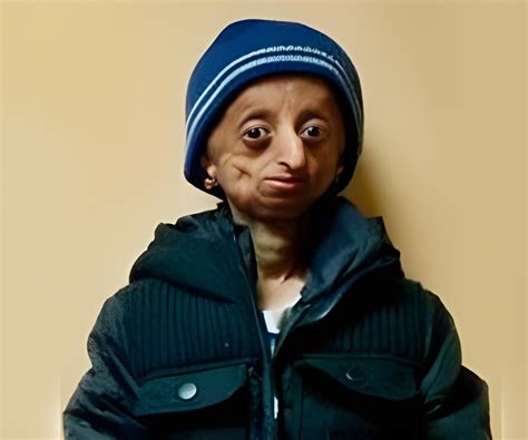 Dna Editing Technique Shows Promise To Treat Progeria Aging Disorder
