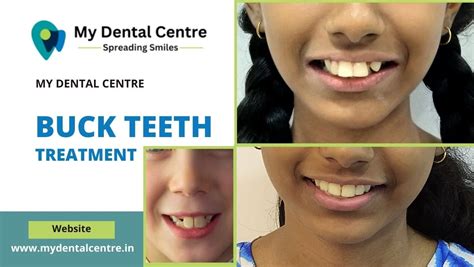 Buck Teeth Solution