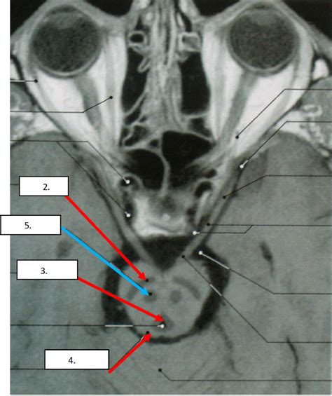 Ifs Lab 1 Midbrain Superior Diagram Quizlet