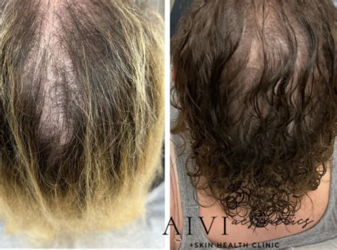 Prp Hair Loss Treatment Agoura Hills Unlock Hair Regrowth