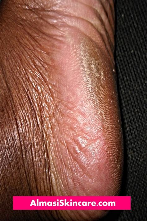 Dry Cracked Feet Treatment In Kenya Almasi Skincare