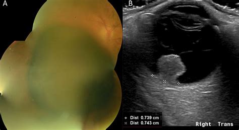Choroidal Melanoma