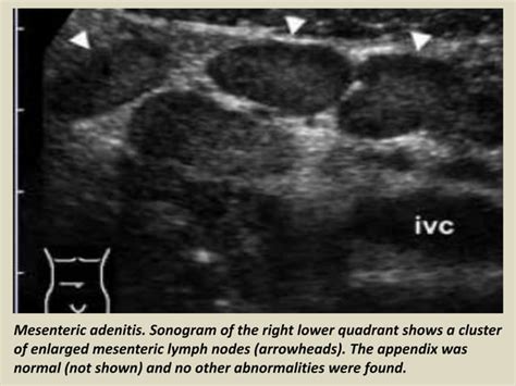 Presentation1 Pptx Ultrasound Examination Of The Appendix Pptx