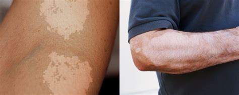 Tinea Versicolor Vs Vitiligo Ive Struggled With Tinia Versicilor