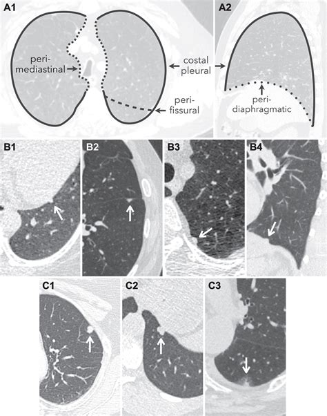 Acr Lung Rads V2022 Assessment Categories And Management