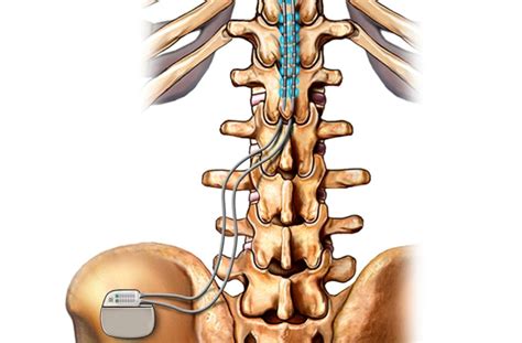 Spinal Cord Stimulation Allspine Laser And Surgery Centers Ga